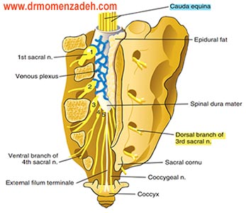 بلاک اعصاب ساکرال - Sacral با روش ترانس ساکرال - Transsacral تحت هدایت ...