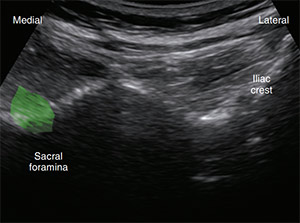 بلاک اعصاب ساکرال - Sacral با روش ترانس ساکرال - Transsacral تحت هدایت ...