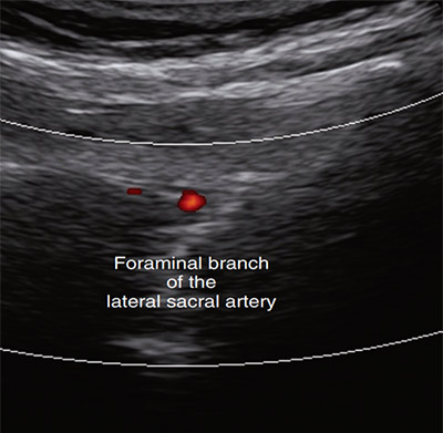 بلاک اعصاب ساکرال - Sacral با روش ترانس ساکرال - Transsacral تحت هدایت ...