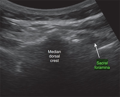 بلاک اعصاب ساکرال - Sacral با روش ترانس ساکرال - Transsacral تحت هدایت ...